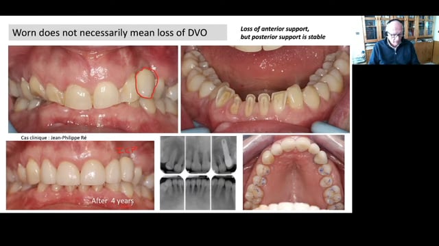 Webinar on choosing the position and inclination of teeth