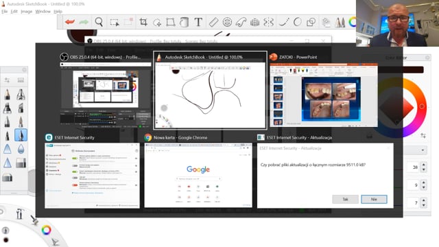 Webinar on protocols of open/closed sinus lift, using CBCT