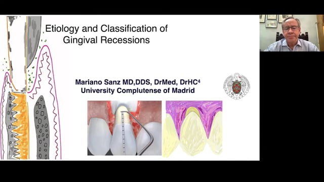 Webinar on apical displacement of the gingival margin, flaps
