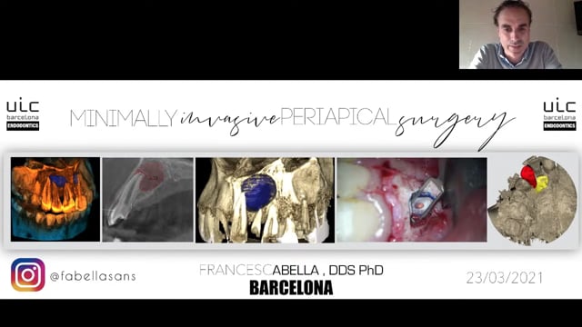 Apical surgery, root apical resection, replantation, webinar