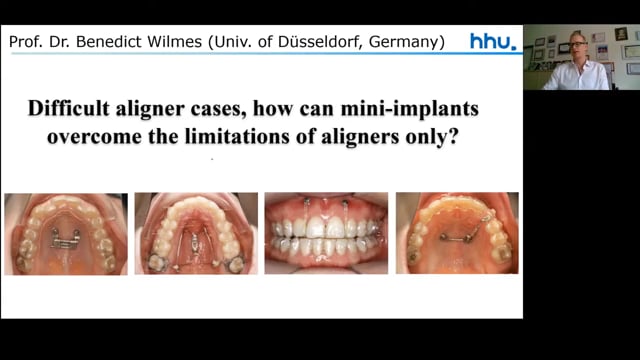 Webinar of difficult cases treatment protocols with aligners