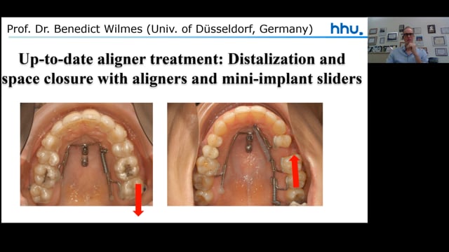 Distalization and space closure with aligners, online lesson