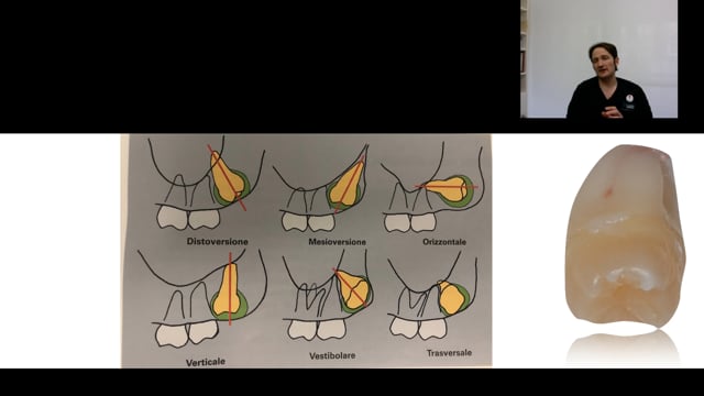 Webinar on piezosurgical approach to extraction, third molar