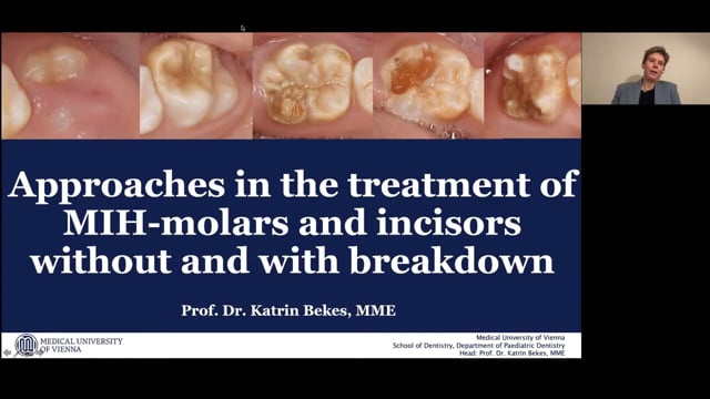 Treatment of MIH, direct and indirect techniques, webinar