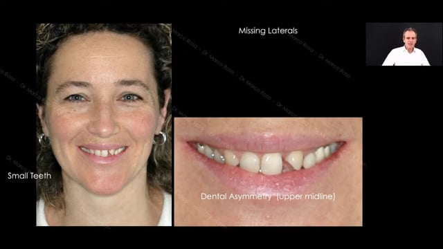 Lateral incisor adentia, dental asymmetry, online lesson