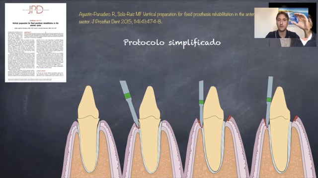 Protocolo clínico de la técnica BOPT. Tallado dental