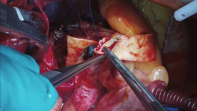 Bio-Bentall and hybrid arch frozen elephant trunk repair for acute type ...