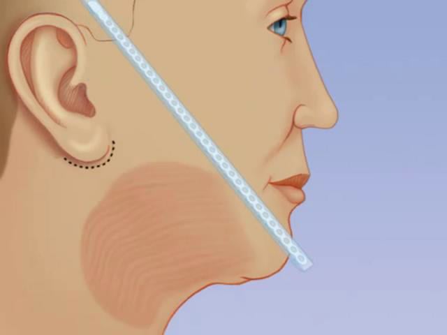 Endotine Ribbon Neck Animation on Vimeo