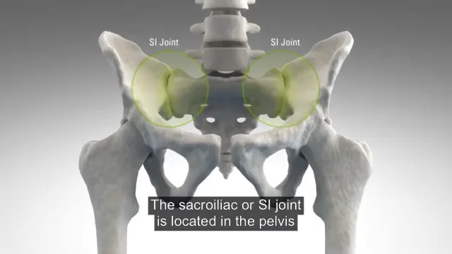 Sacroiliac Joint Fusion with the iFuse Implant System