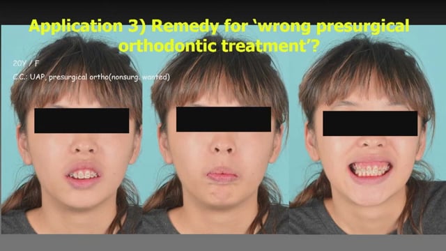 Total arch intrusion in hyperdivergent Class 2 face: a replacement ...