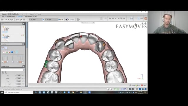 The interproximal enamel reduction during aligner treatment