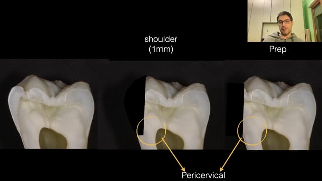 Surgical crown lengthening and vertical preparation to recover severely ...