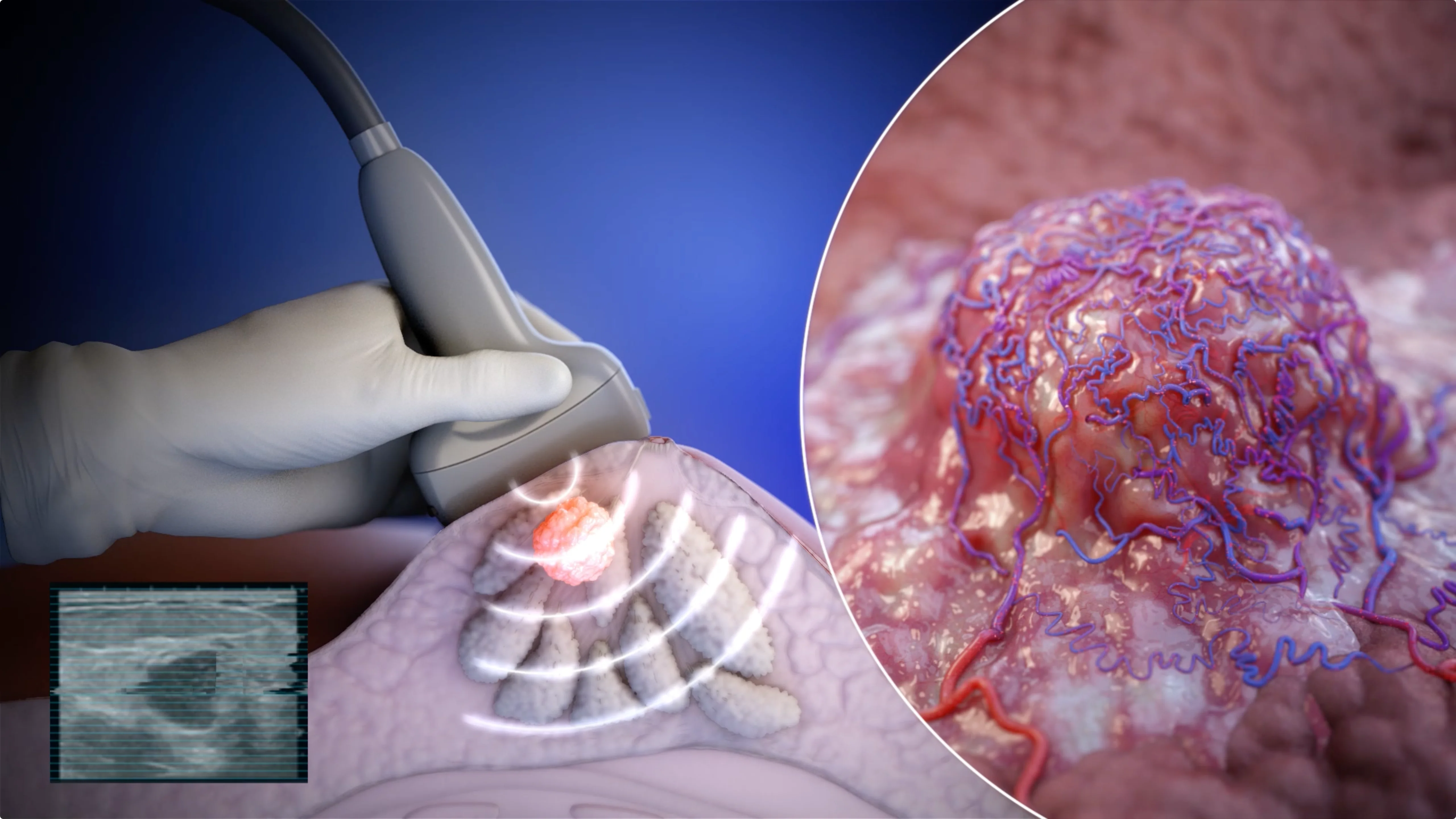 Seno Medical Opto-Acoustic Technology Animated Video