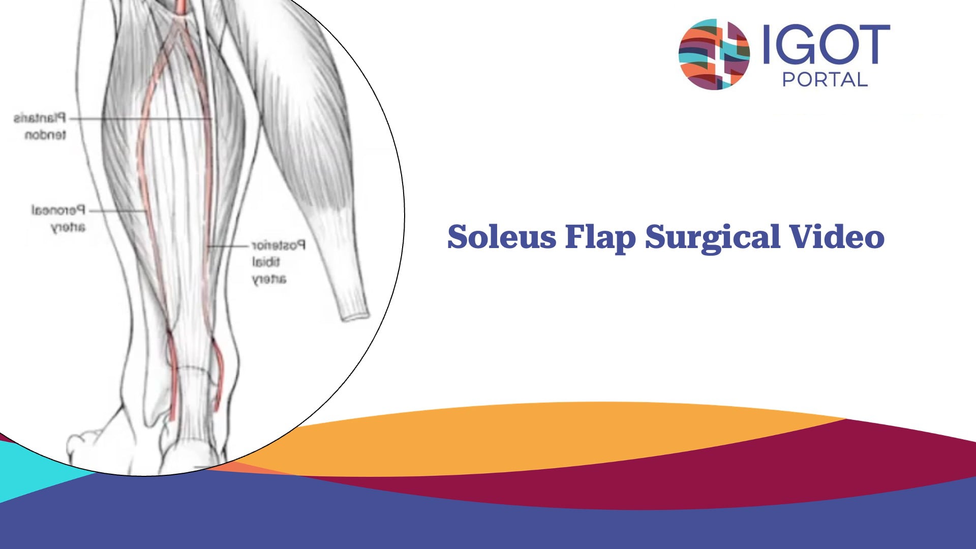 Soleus Flap | Surgical Video