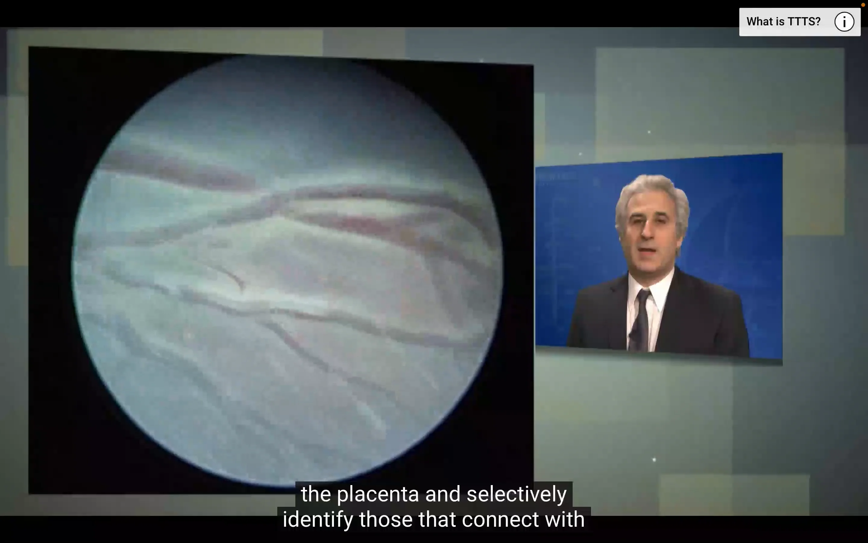 Twin-to-Twin Transfusion Syndrome | Fetoscopic Laser Ablation Surgical ...