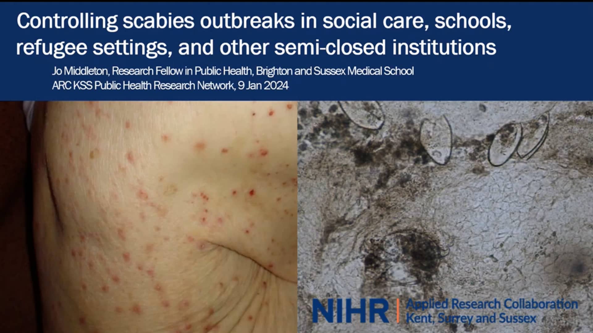 Controlling scabies outbreaks in social care, schools, refugee settings ...