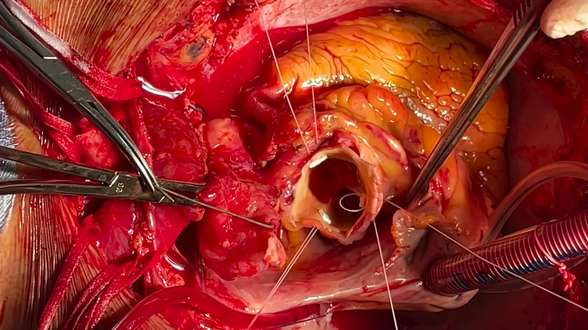 Aortic valve resuspension using the Florida sleeve technique with ...
