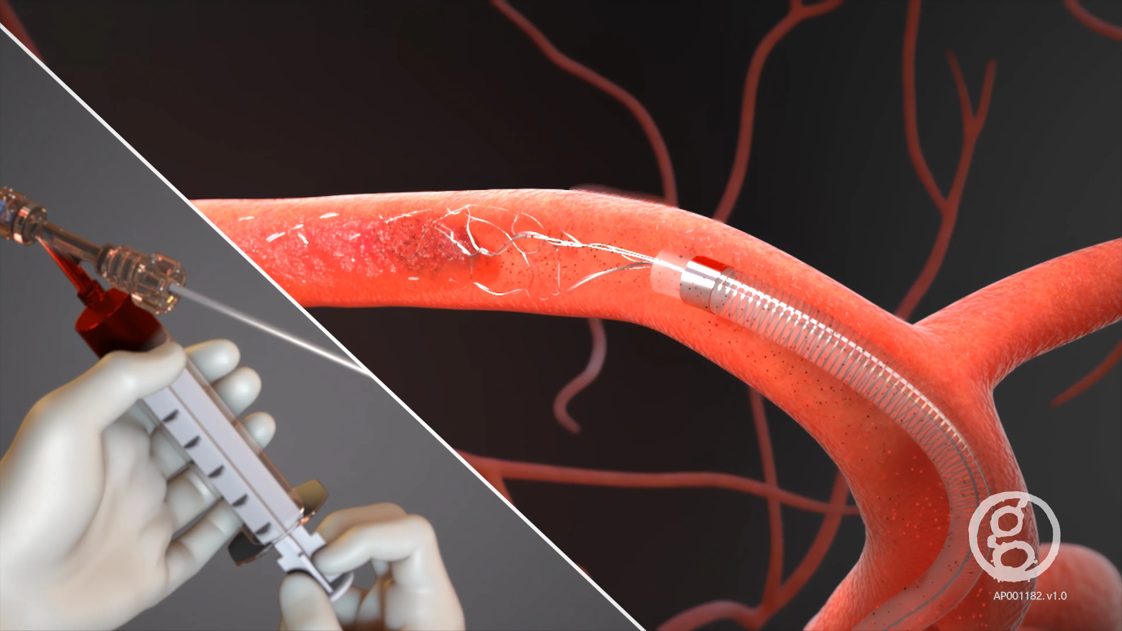 Stryker Trevo NXT for Stroke Treatment | 2018 Cardiovascular Animation ...