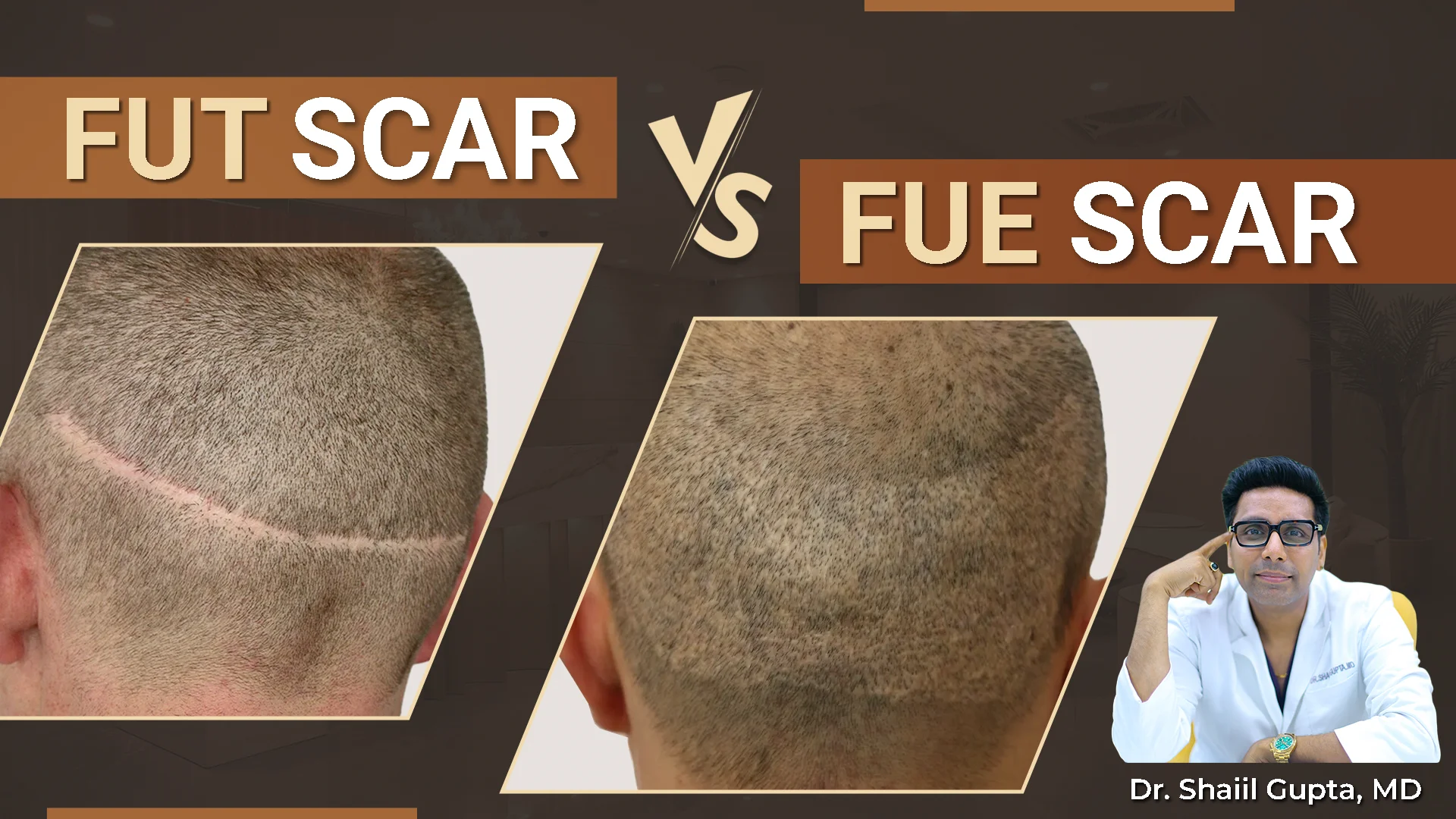 FUT VS FUE scar on Vimeo