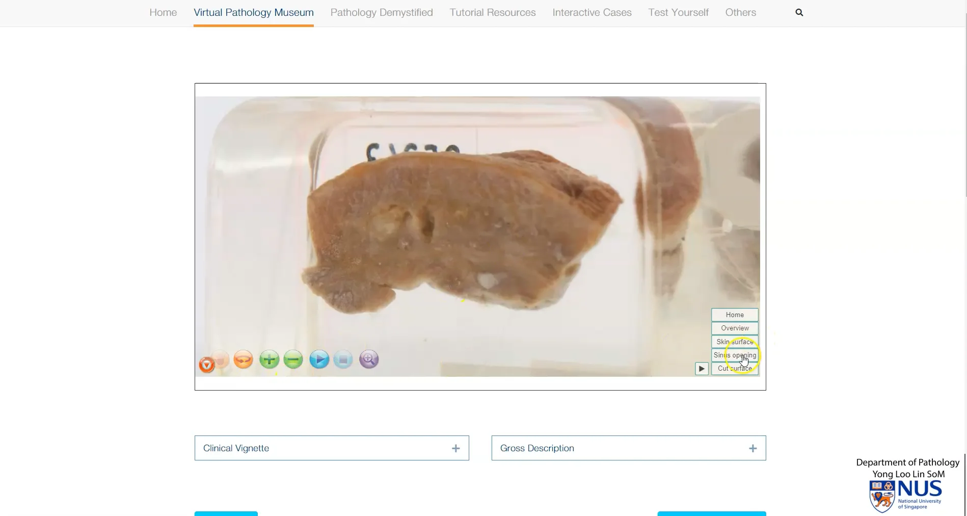 Skin - Carbuncle (Gross pathology) on Vimeo