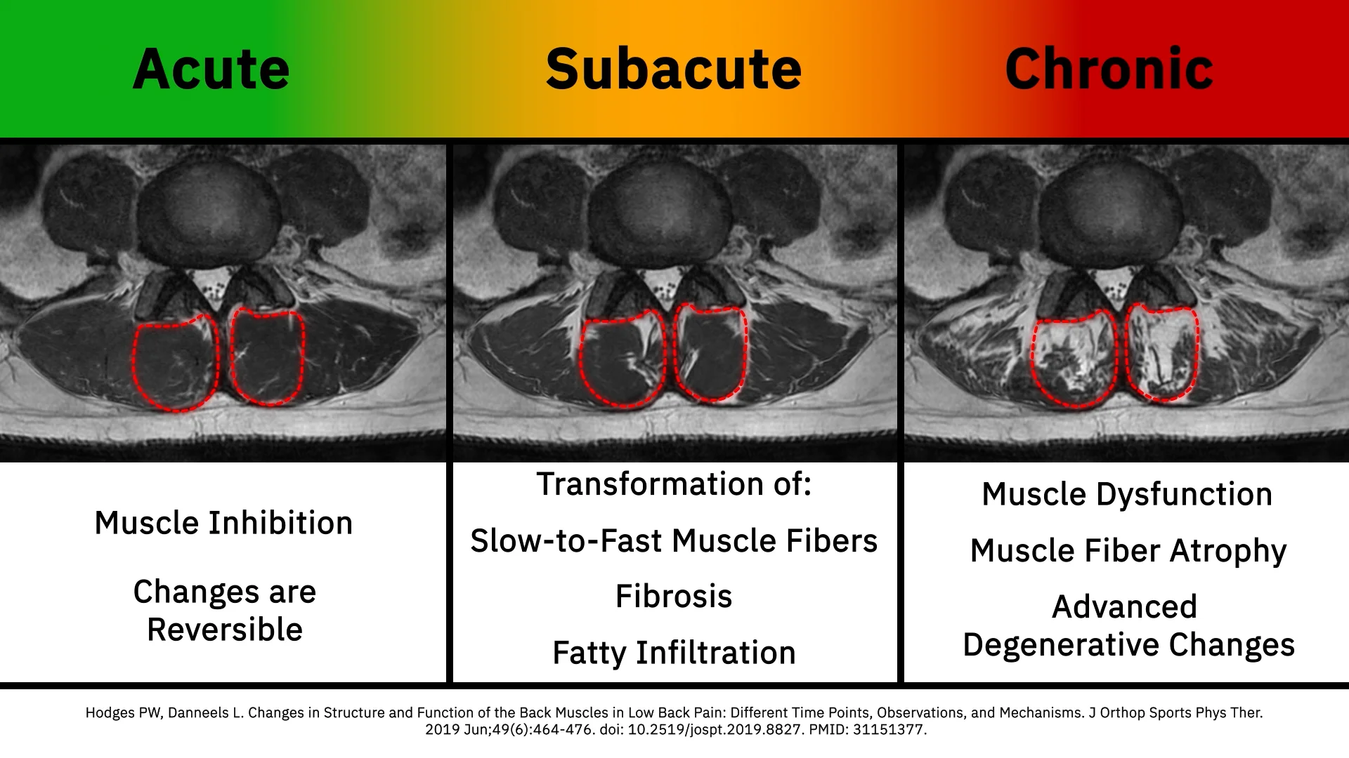 Multifidus Muscle Atrophy Simulation Over Time on Vimeo