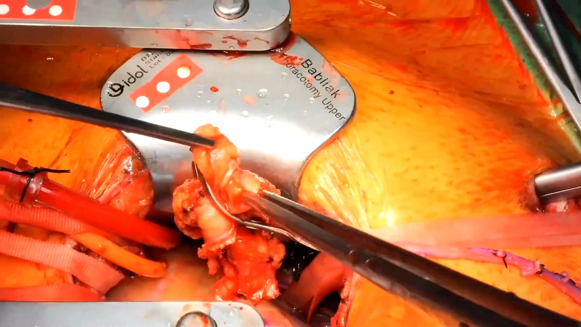 Robotic-assisted minimally invasive multivessel coronary bypass surgery ...
