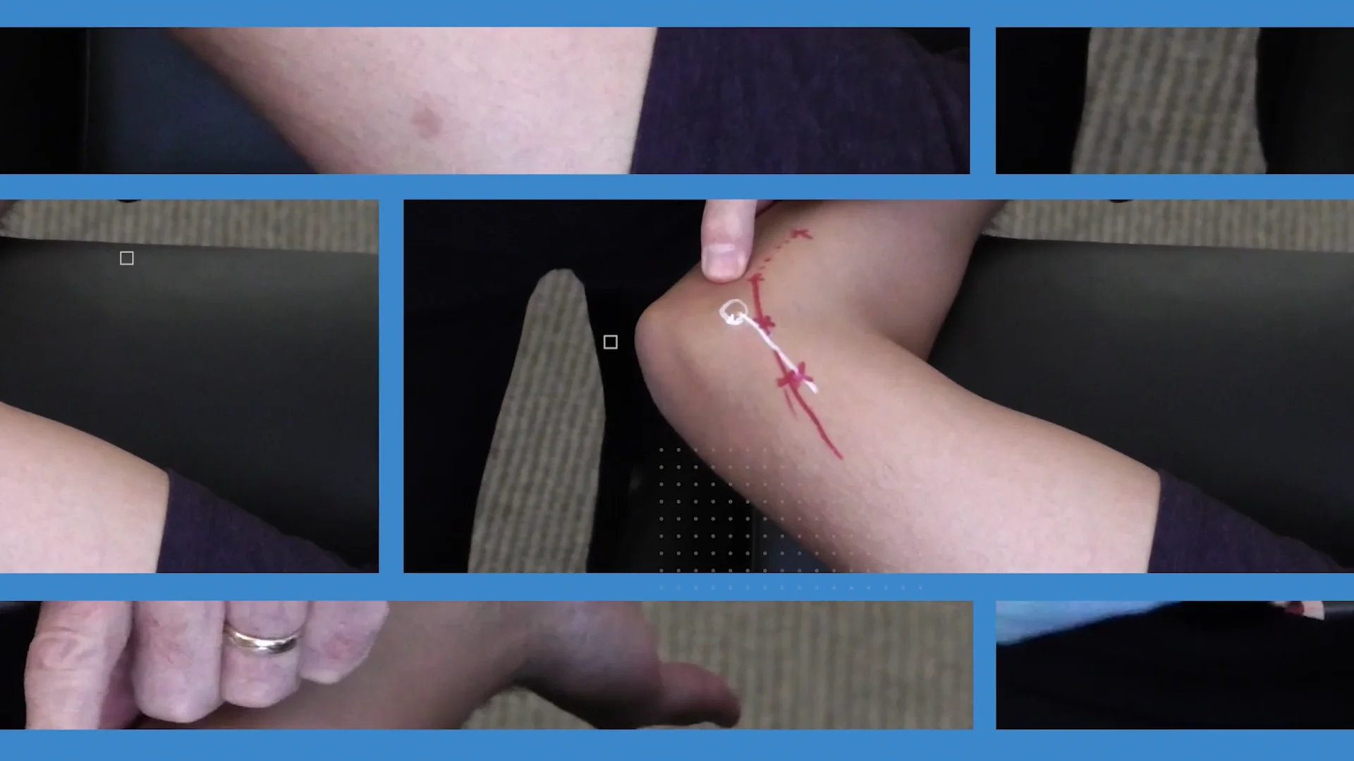 Watch Lyftogt Perineural Injection Treatment: How to Treat Peripheral ...