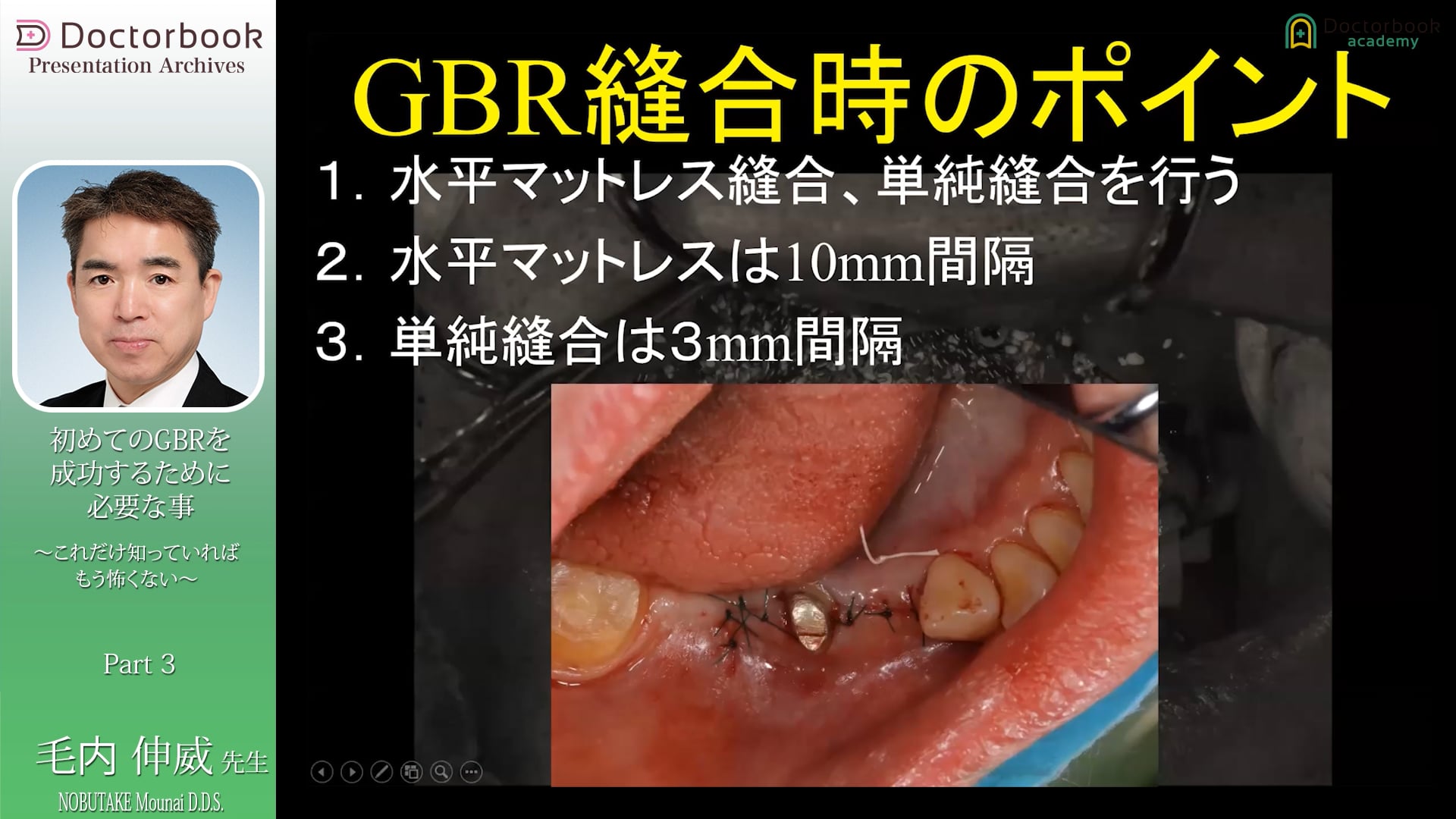 専門医はこうする！！～GBR法の実際～ part2 #3 | Doctorbook academy (ドクターブックアカデミー)