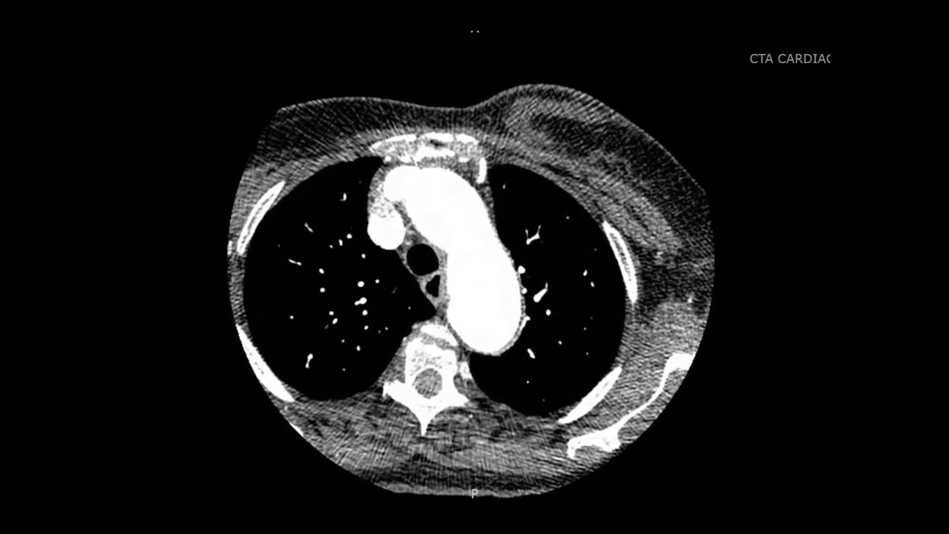 Non-circulatory arrest aortic arch replacement | MMCTS