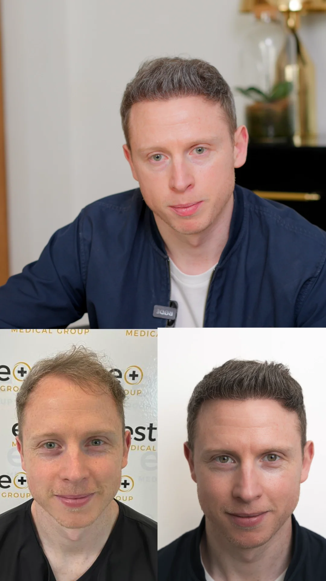 Anthony Potts - 8 months post Hair Transplant - Este Medical on Vimeo