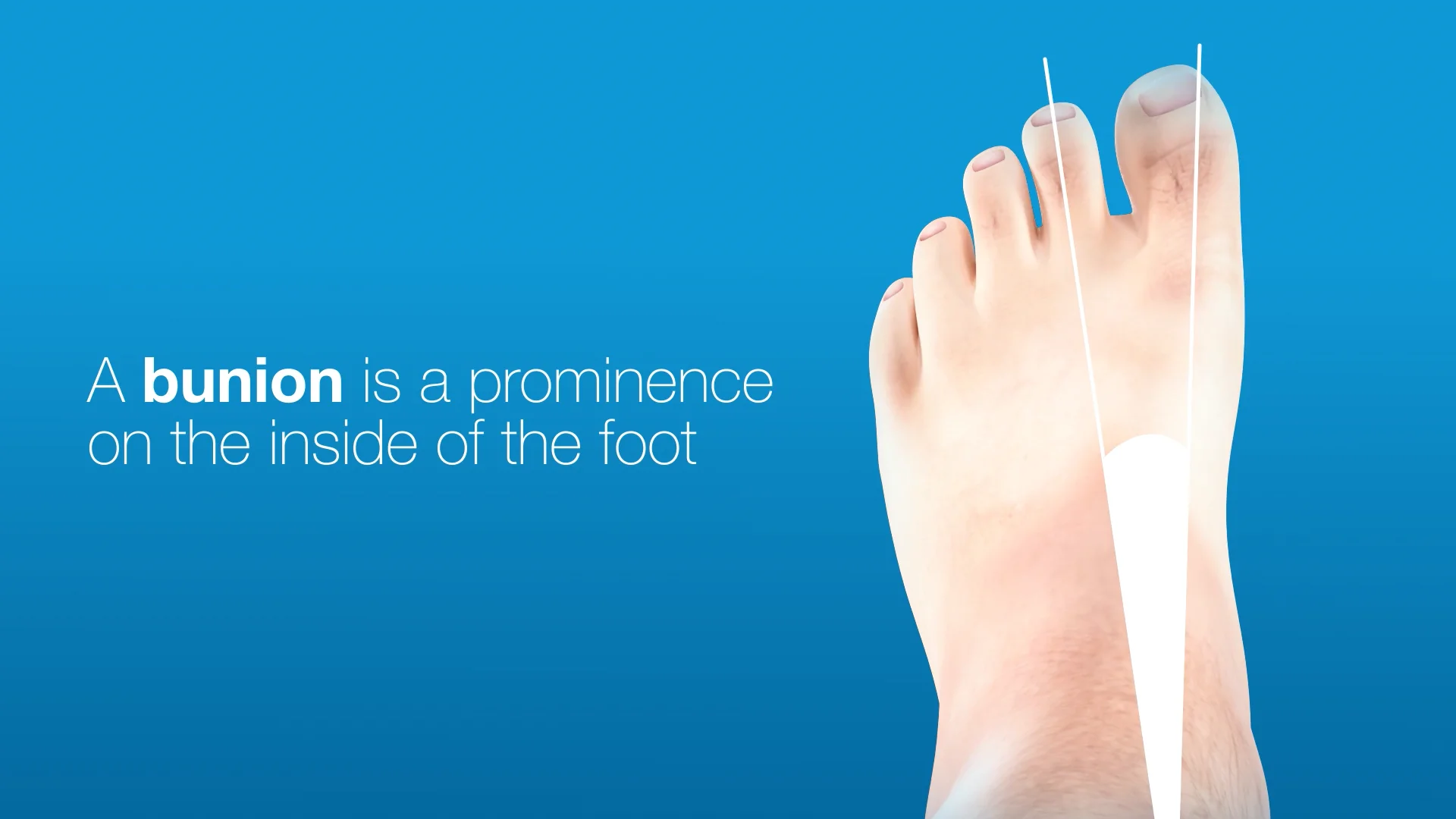 MIS Centrolock Bunion Correction