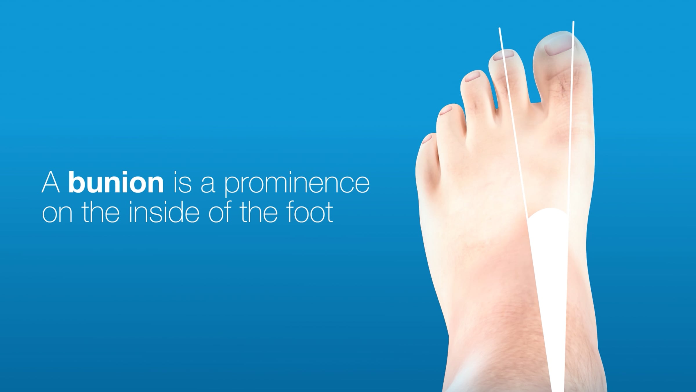 MIS Centrolock Bunion Correction