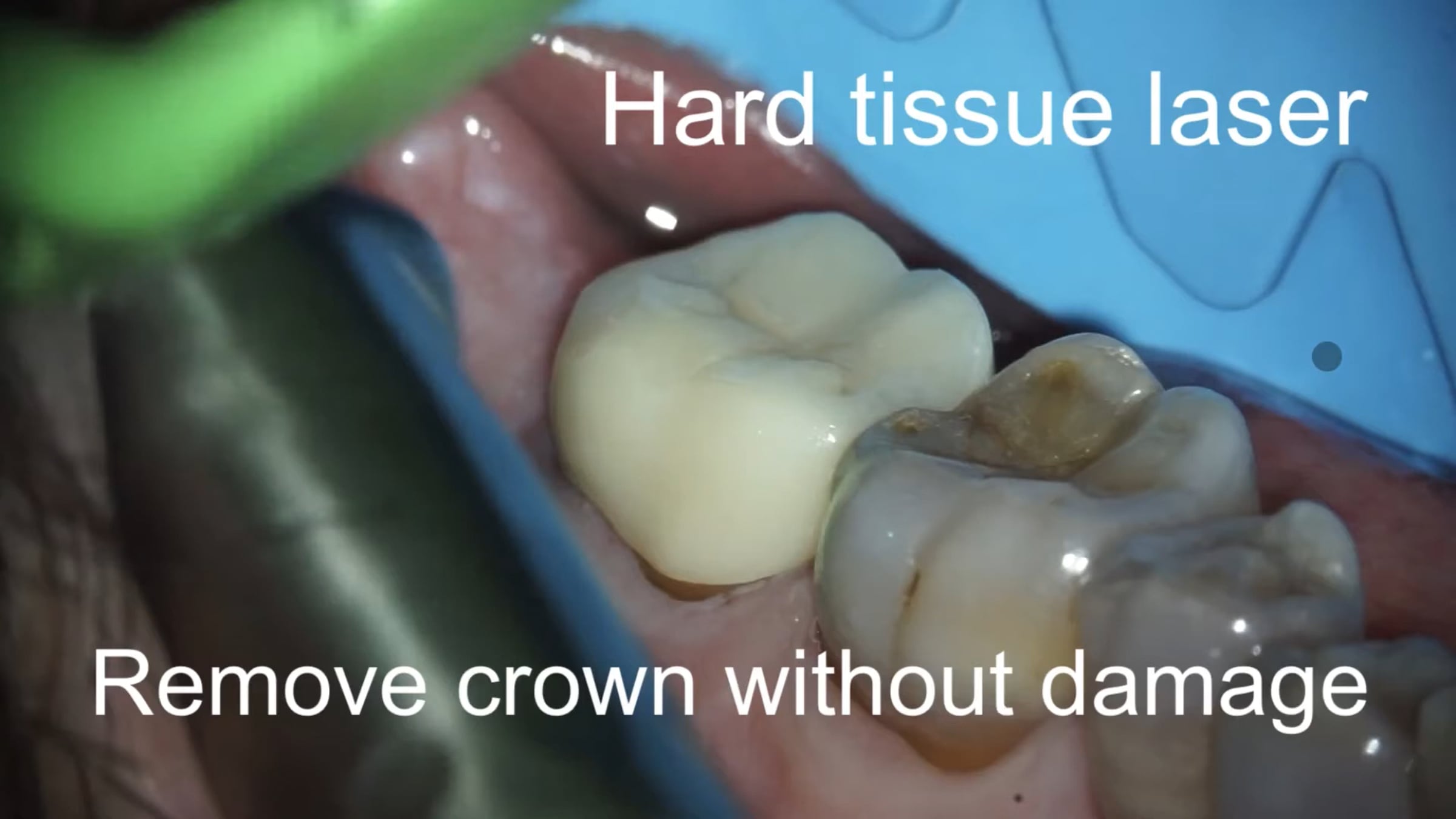 Porcelain crown removal with Fotona Laser