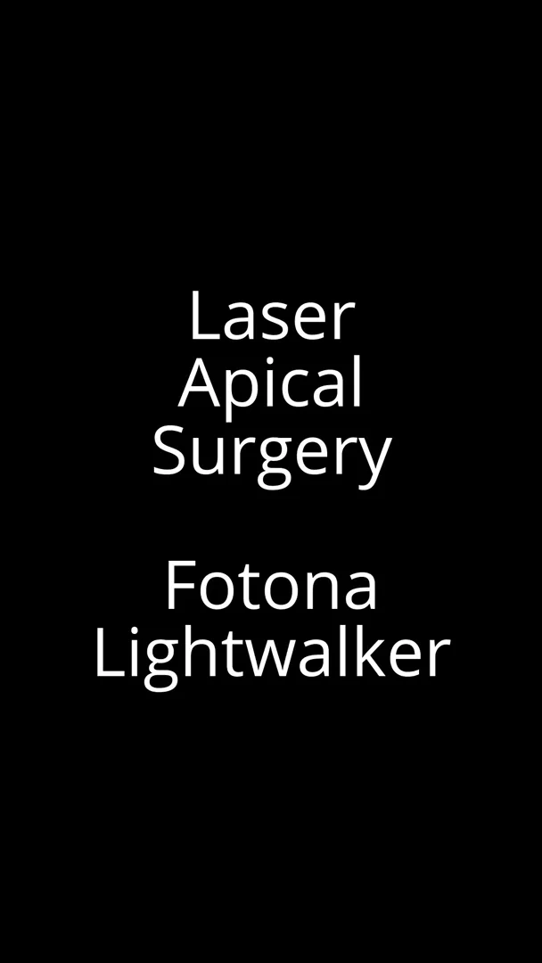 Laser Apicoectomy - Fotona Lightwalker