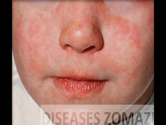 Scarlet Fever (Scarlatina) on Vimeo