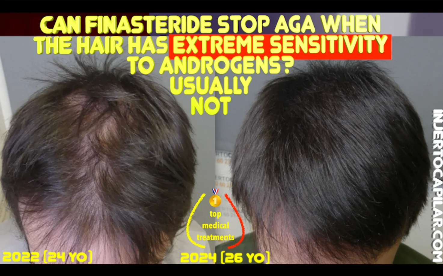 Short term: 2 yrs. Can finasteride stop AGA when the hair has extreme ...