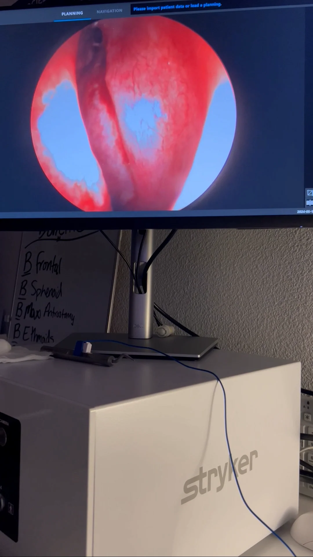 Sinusoft Ethmoidectomy RAW footage on Vimeo