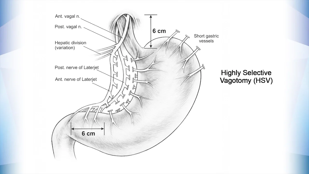 ch06 sec01 Vagus Nerves (truncal and highly selective vagotomy) on Vimeo