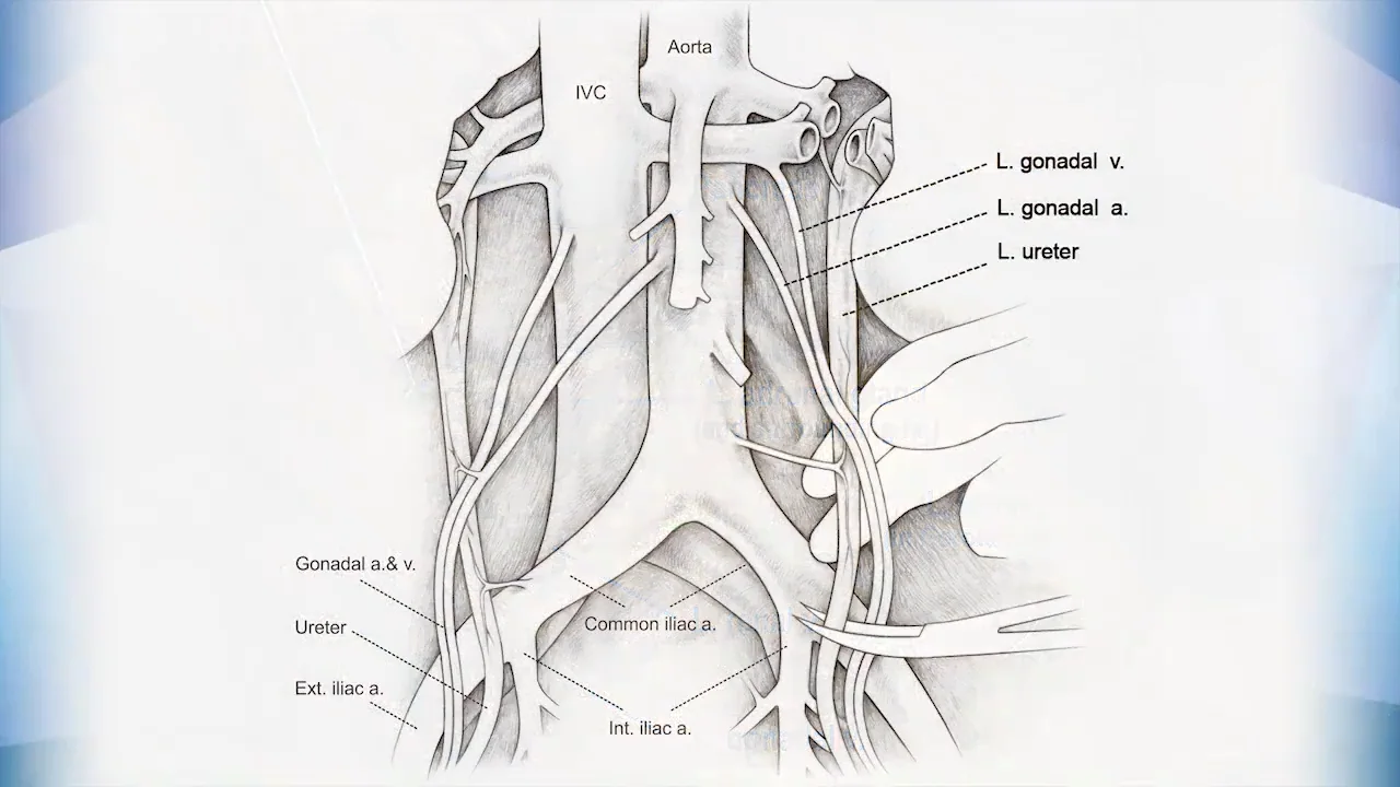 ch08 sec03 Left Kidney (left radical nephrectomy)