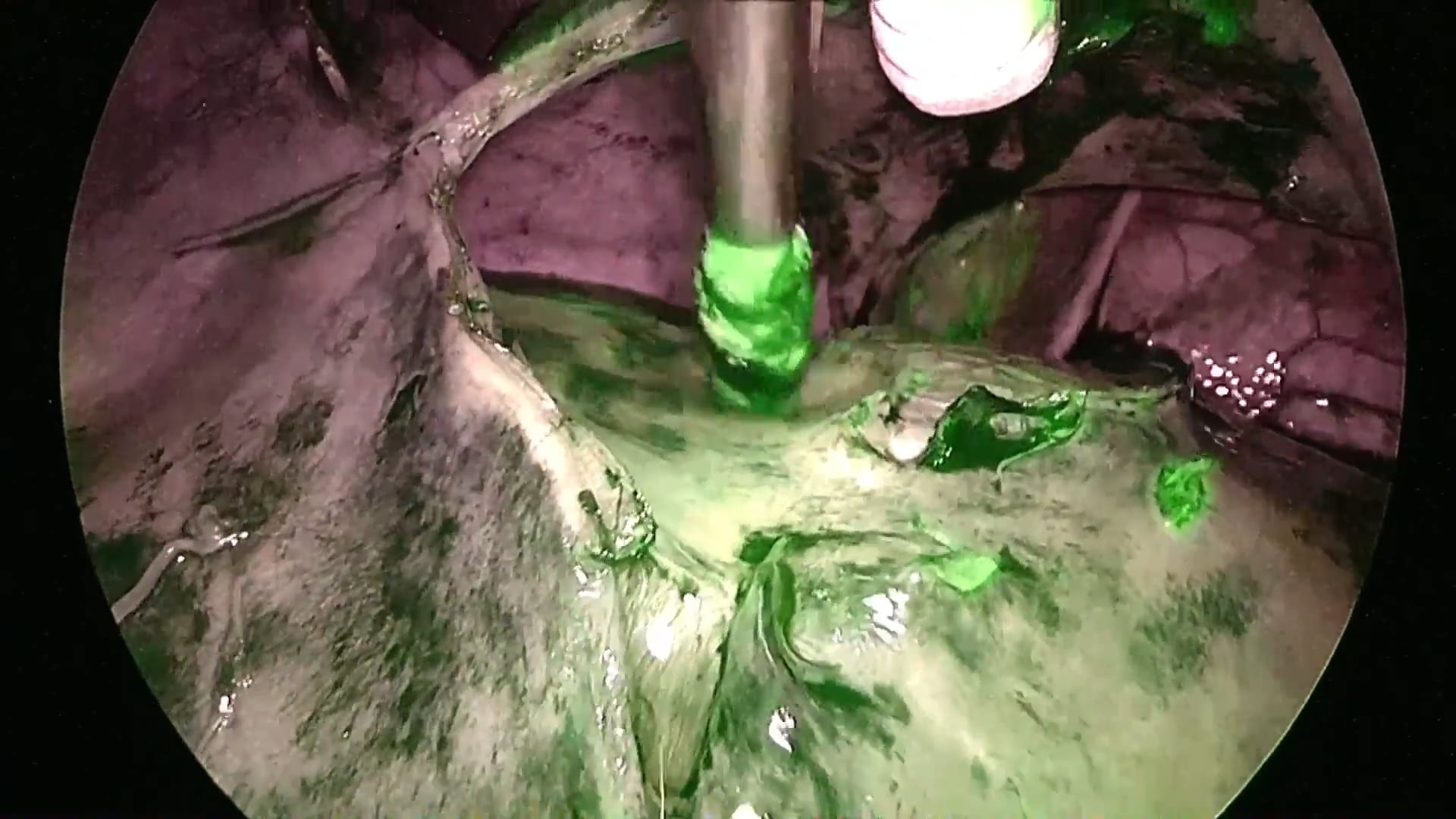 An indocyanine green fluorescence-guided operation for diagnosing and ...