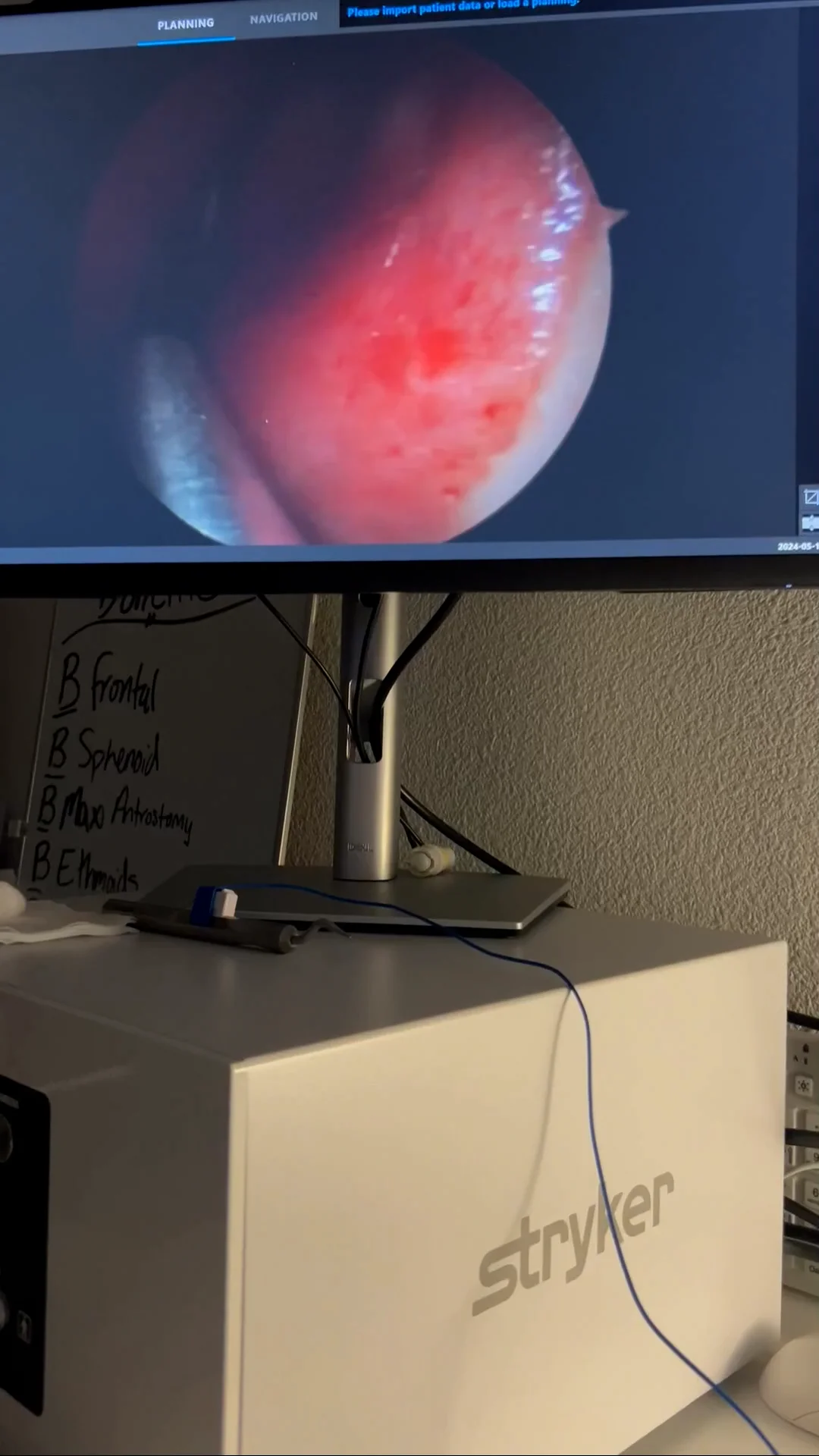 Sinusoft Clearing Fungal Sinusitis: RAW on Vimeo