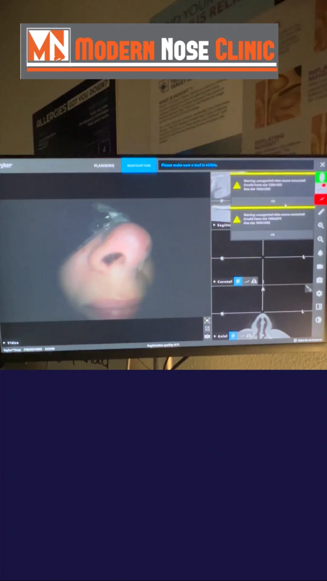 Sinusoft Procedure: Step 5 = Patient Tells All on Vimeo