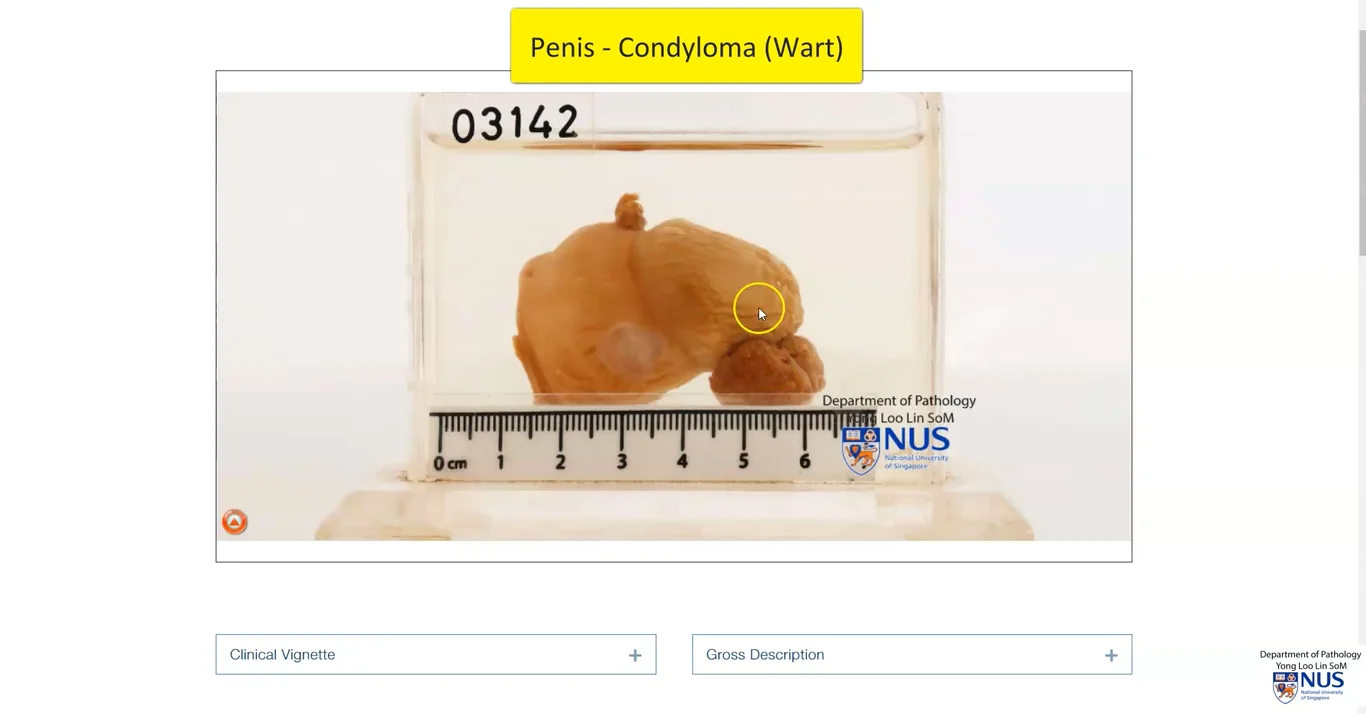 Penis - Condyloma acuminatum/Wart (Gross pathology) on Vimeo