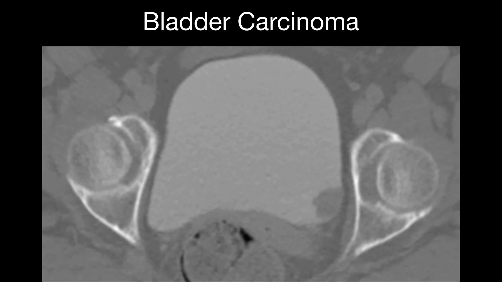 Bladder Carcinoma on Vimeo