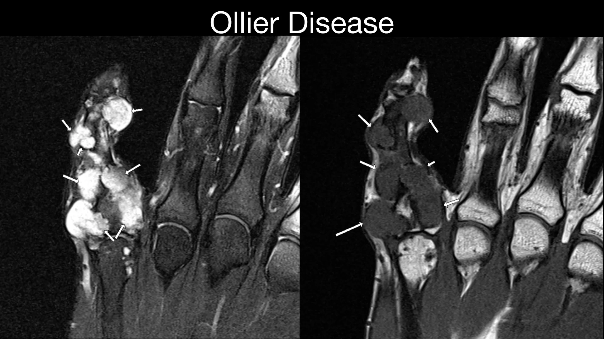 Ollier Disease on Vimeo