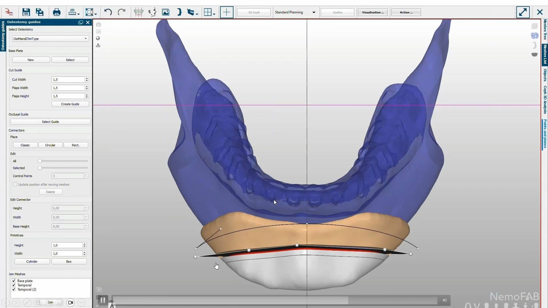 Webinar Orthognathics. Design of Osteotomy guides version 24 on Vimeo