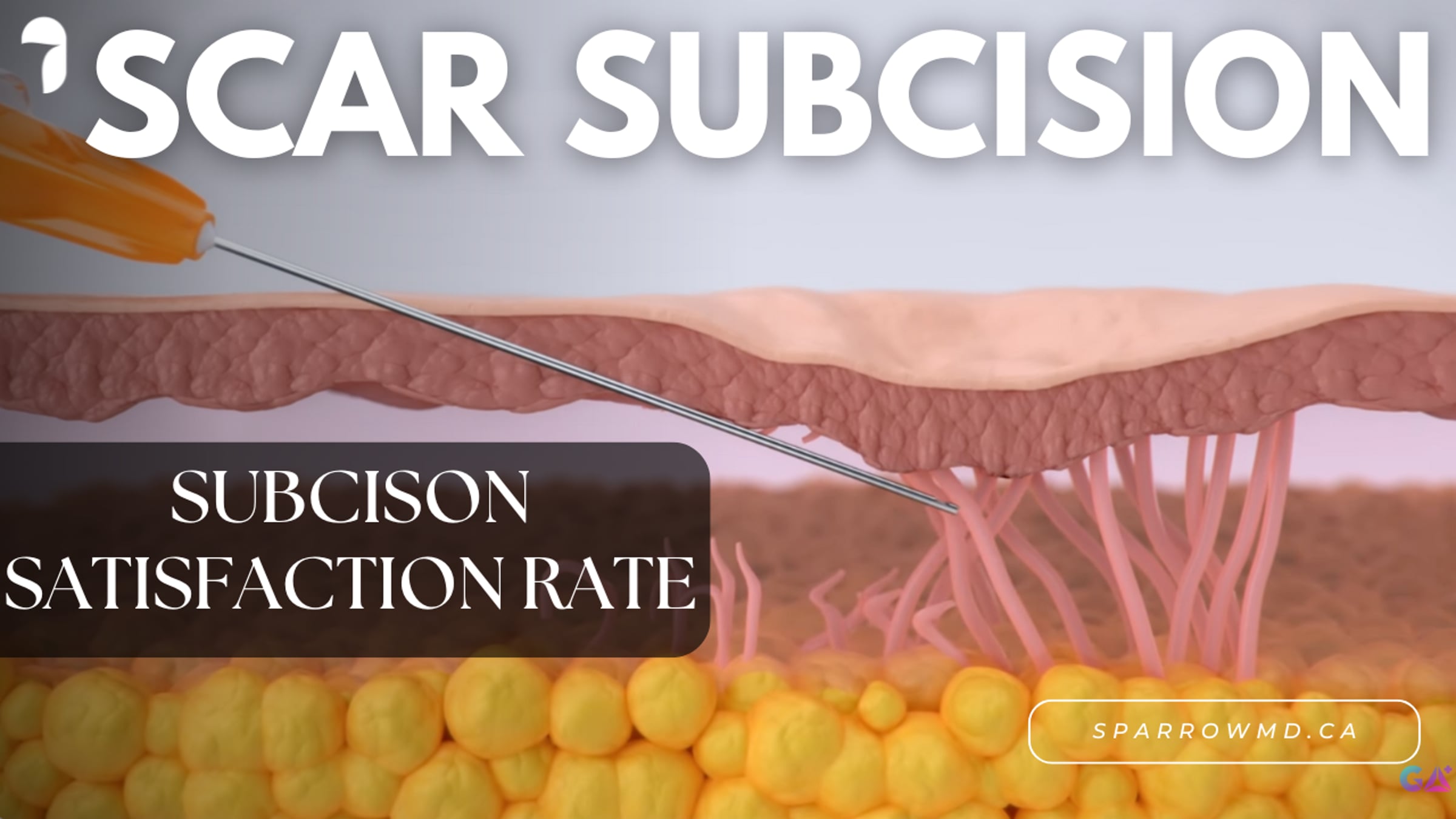 Acne Scars Subcision Satisfaction Rate