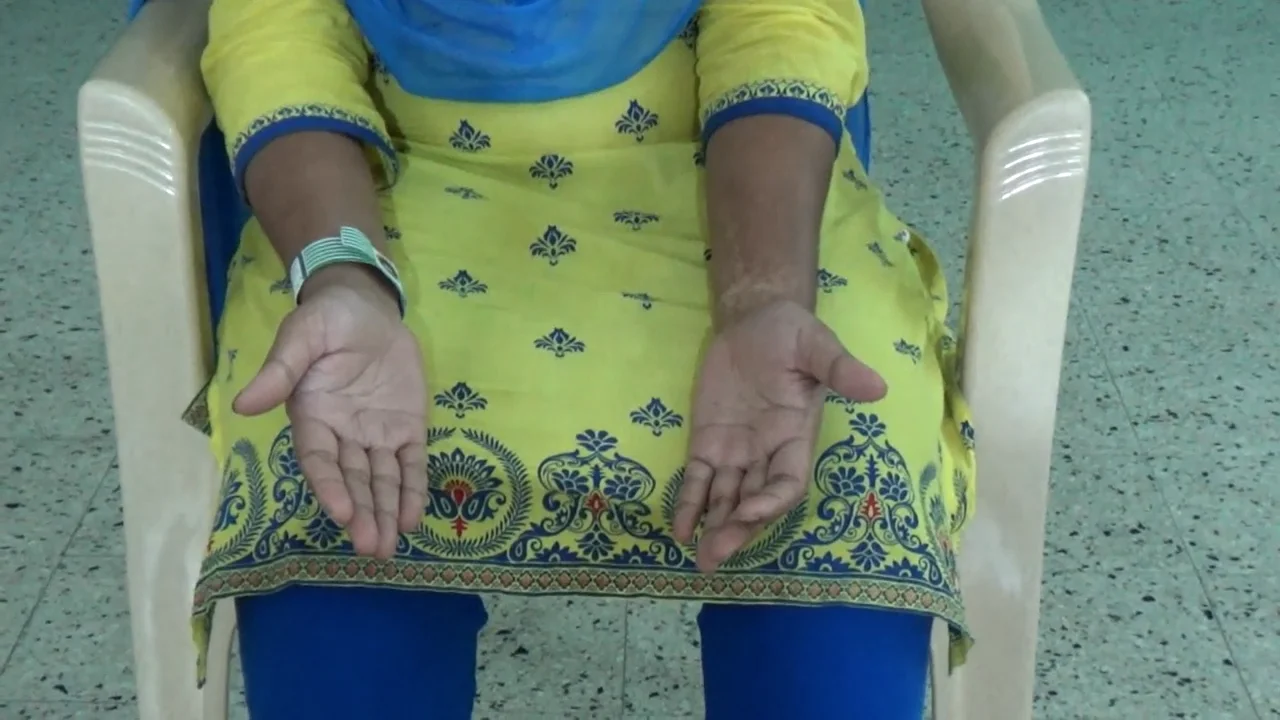 Video of Patient-13 with complicated Hereditary Spastic Paraparesis