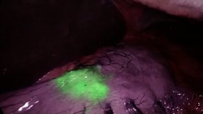 Laparoscopic total gastrectomy using indocyanine green (ICG) for lymph ...