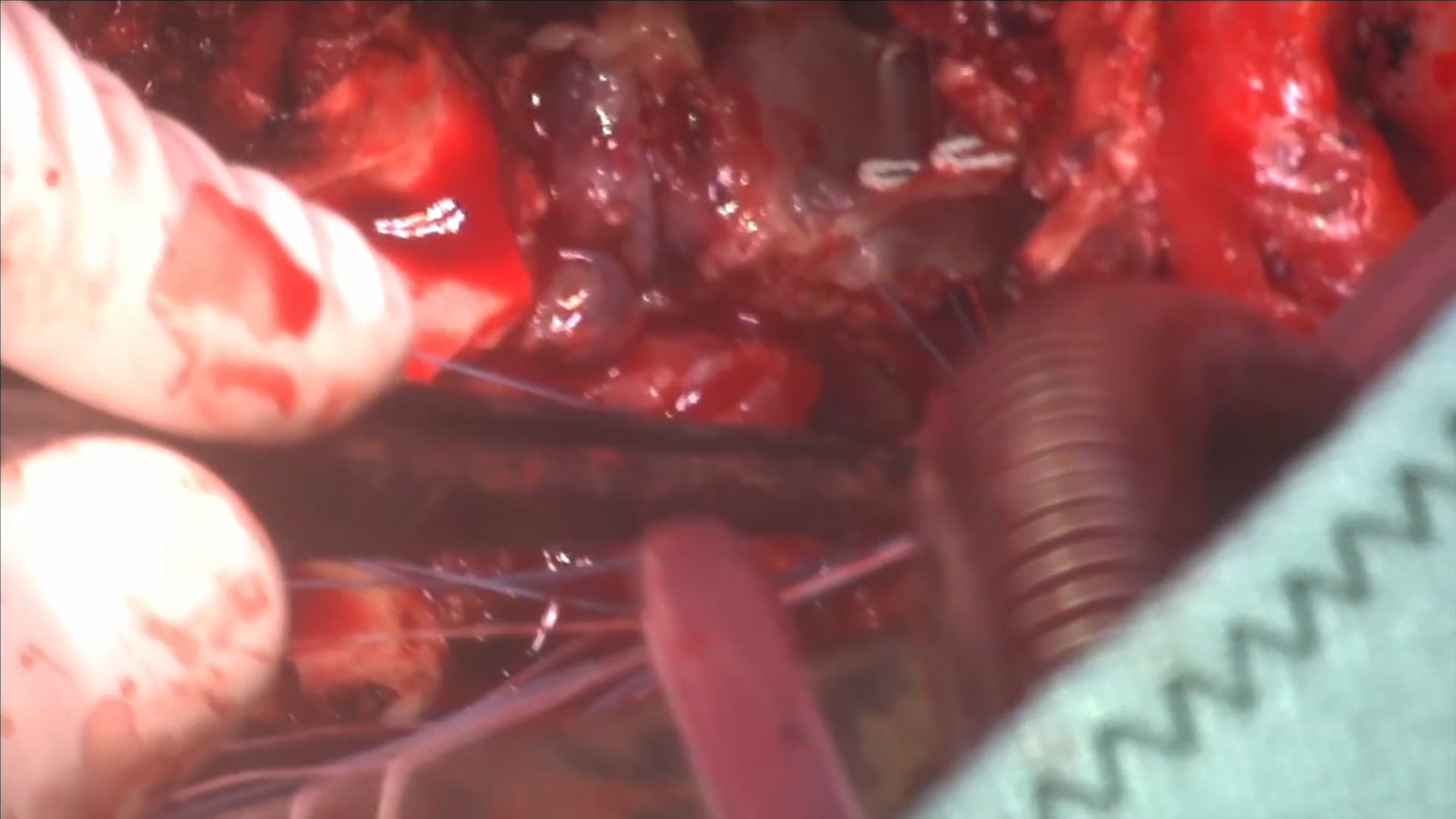 The Commando procedure for mechanical double valve prosthesis ...